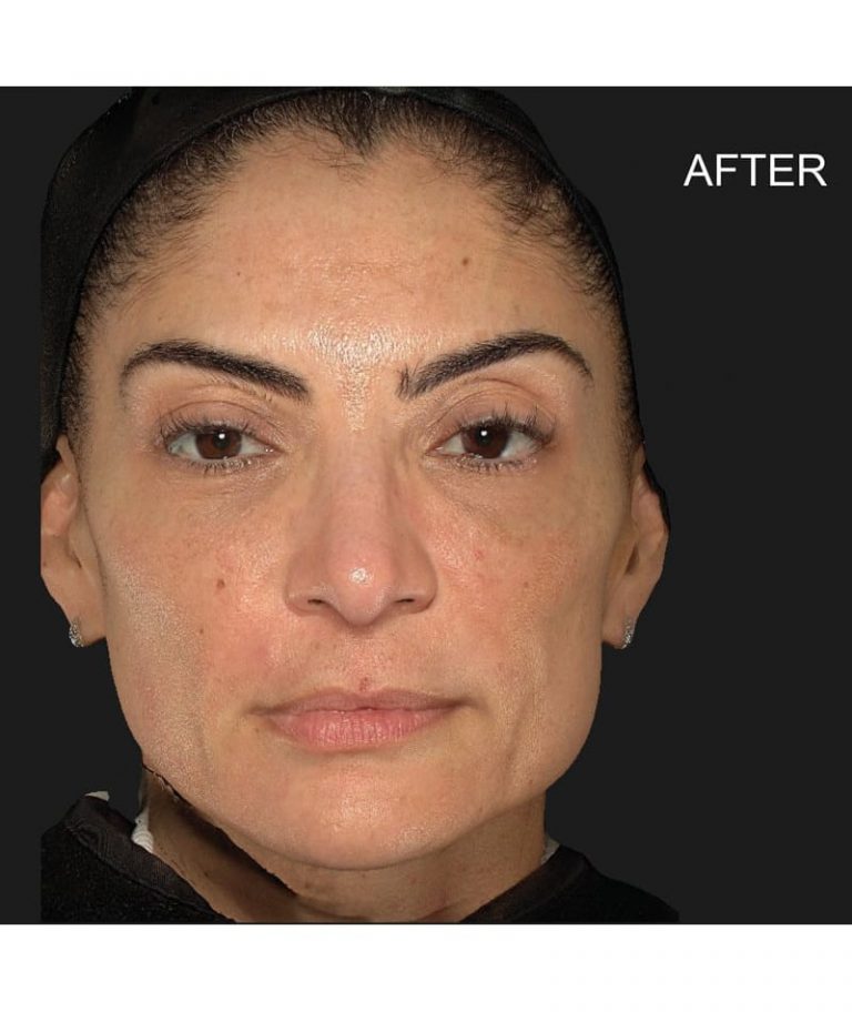 25-45um 医美用CaHA羟基磷灰石微球 - 上海伊普瑞生物