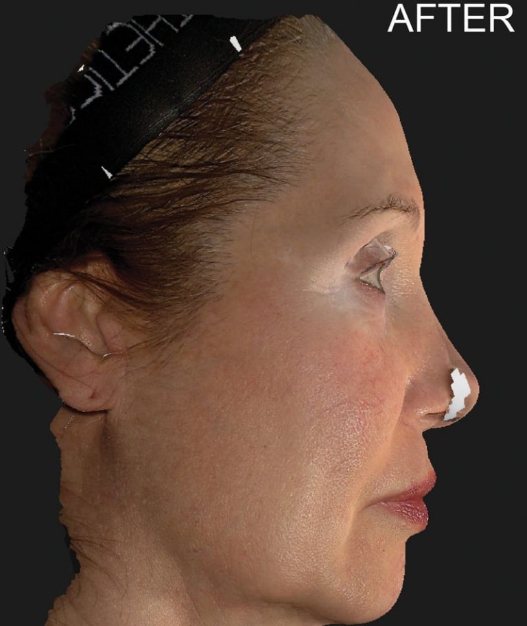 25-45um 医美用CaHA羟基磷灰石微球 - 上海伊普瑞生物