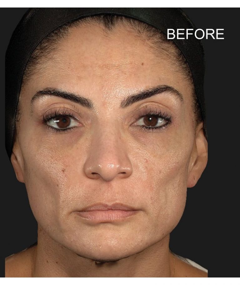 25-45um 医美用CaHA羟基磷灰石微球 - 上海伊普瑞生物